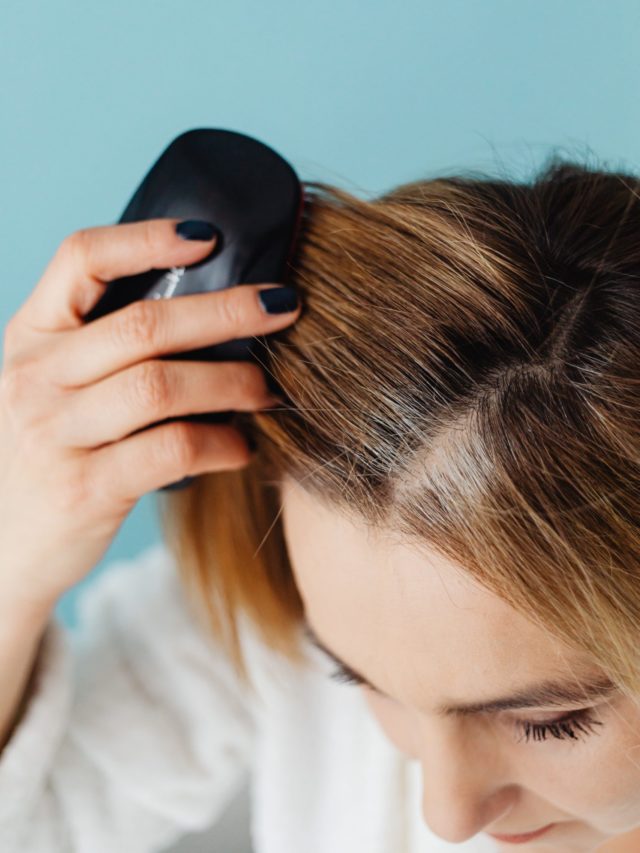 ¿qué Es La Alopecia Infobae Stories